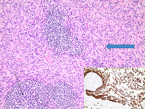Unusual Presentation of Cutaneous Spindle Cell Squamous Cell Carcinoma ...