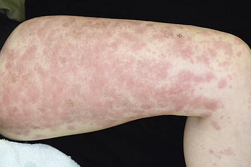 Varicella Zoster Virus-Associated Meningitis as a Rebound Varicella ...