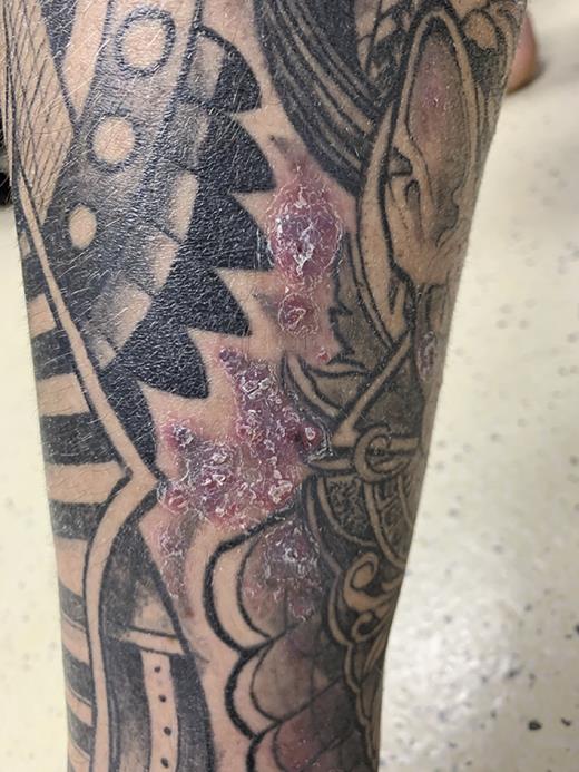 Tattoo-Associated Cutaneous Mycobacterium mageritense Infection: A Case ...