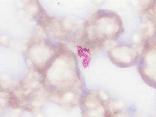 Lucio Phenomenon: An Unusual Case of Skin Necrosis | Case Reports in ...