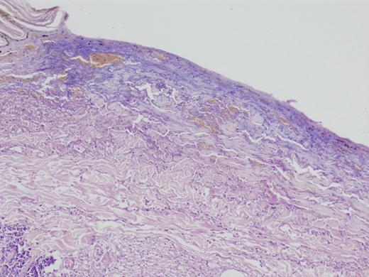 Lucio Phenomenon: An Unusual Case of Skin Necrosis | Case Reports in ...