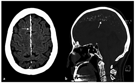 Incidental Finding of Lamellar Calcification of the Falx Cerebri ...