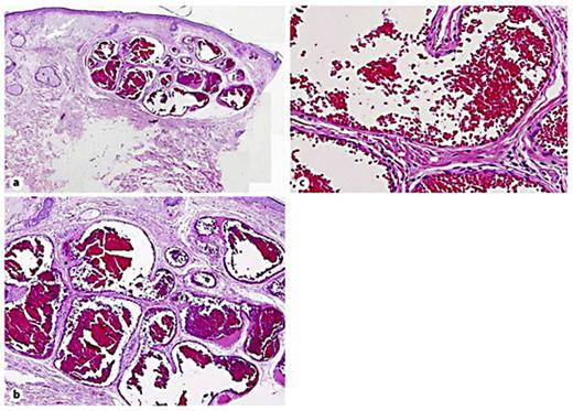 Blue Rubber Bleb Nevus Syndrome Showing Vascular Skin Lesions ...