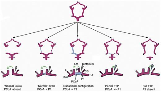 The Fetal Variant of the Circle of Willis and Its Influence on the ...