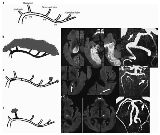Posterior Cerebral Artery Infarction: Diffusion-Weighted MRI Analysis ...