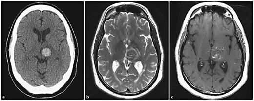 Utility of Early MRI in the Diagnosis and Management of Acute ...