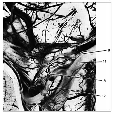 The Intracranial Vertebral Artery: A Neglected Species ...