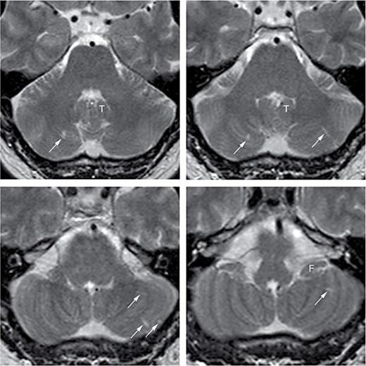 Very Small Cerebellar Infarcts: Integration of Recent Insights into a ...