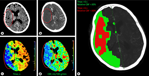 Wake-Up Stroke versus Stroke with Known Onset Time: Clinical and ...
