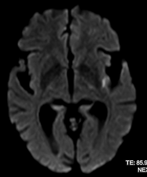 Isolated Insular Stroke: Clinical Presentation | Cerebrovascular ...