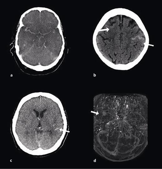 Subarachnoid Hemorrhage in Bacterial Meningitis Patients ...