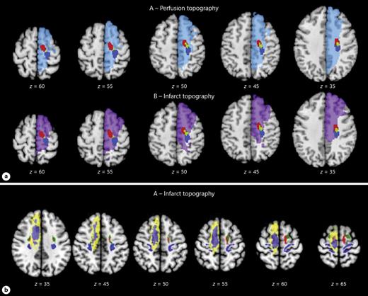 Topographic Evolution of Anterior Cerebral Artery Infarction and Its ...