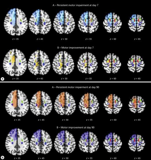 Topographic Evolution of Anterior Cerebral Artery Infarction and Its ...