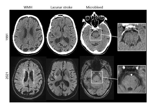 Cerebral Small-Vessel Diseases: A Look Back from 1991 to Today ...