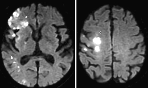 Cortical and Internal Watershed Infarcts Might Be Key Signs for ...