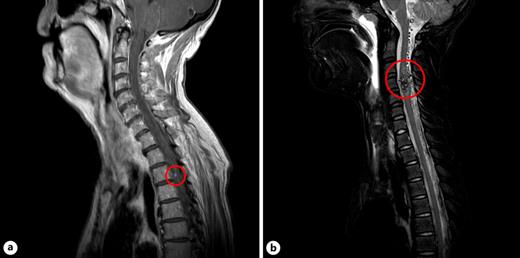 Frequency and Characteristics of Spinal Bleeding Sources in ...