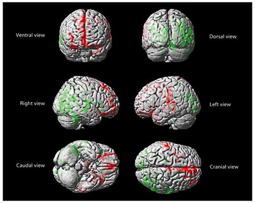 Cerebral Hemodynamic Changes Induced by a Lumbar Puncture in Good-Grade ...