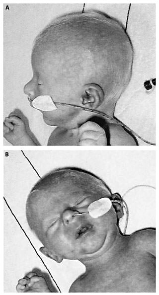 Familial Translocation t(6;20)(p21;p13) Resulting in Partial Trisomy 6p ...