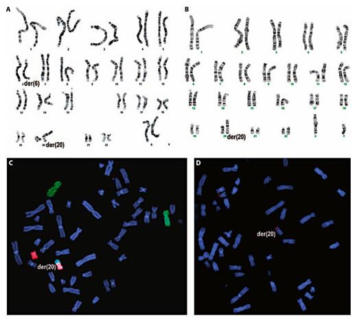 Familial Translocation t(6;20)(p21;p13) Resulting in Partial Trisomy 6p ...