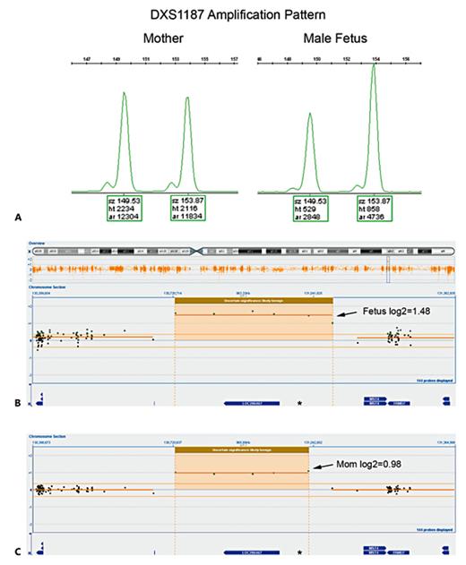 A Challenging Prenatal QF-PCR Rapid Aneuploidy Test Result Caused by a ...