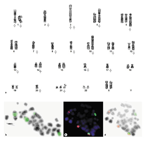 Cytogenetic Abnormalities in Multiple Myeloma: Incidence, Prognostic ...