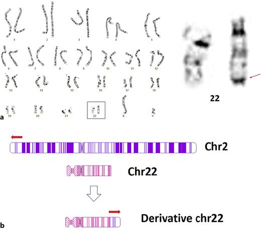 Large Chromosome 2p Duplication-Associated Mechanisms and Clinical ...