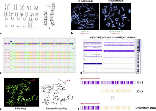 Large Chromosome 2p Duplication-Associated Mechanisms and Clinical ...