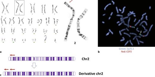 Large Chromosome 2p Duplication-Associated Mechanisms and Clinical ...