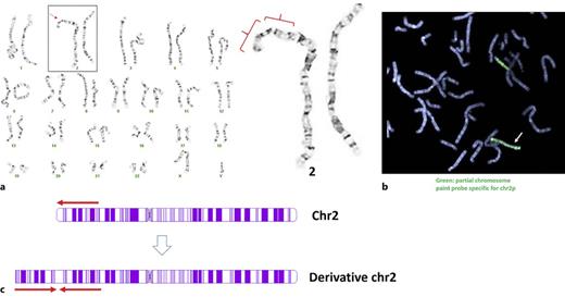 Large Chromosome 2p Duplication-Associated Mechanisms and Clinical ...