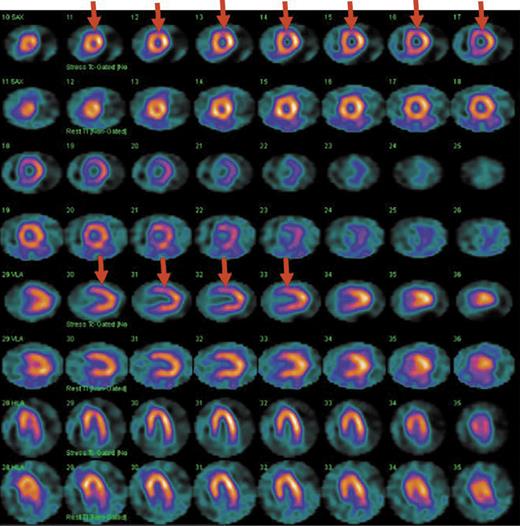 Modern Radiotherapy and Risk of Cardiotoxicity | Chemotherapy | Karger ...