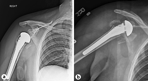 A Proximal Humerus Fracture Dislocation in a Patient with Stiff Person ...