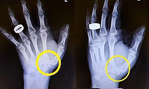 Traumatic Dorsoradial Trapezium-Metacarpal Joint Dislocation | Case ...