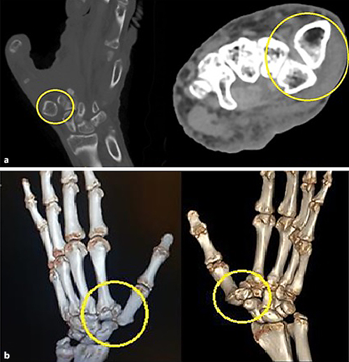 Traumatic Dorsoradial Trapezium-Metacarpal Joint Dislocation | Case ...