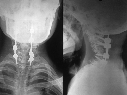 Severe Cervical Spinal Kyphosis: Technical Case Reports on the Way of ...
