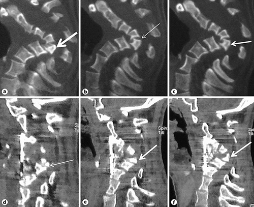 Severe Cervical Spinal Kyphosis: Technical Case Reports on the Way of ...