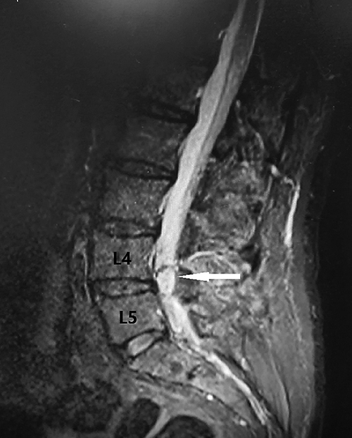 Lumbar Facet Cyst as a Rare Cause of L5 Radiculopathy: A Case Report ...