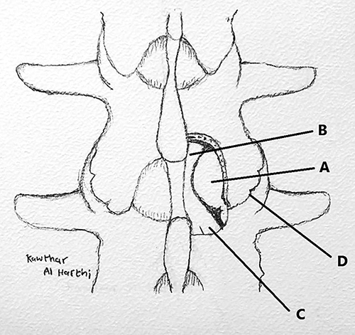 Lumbar Facet Cyst as a Rare Cause of L5 Radiculopathy: A Case Report ...
