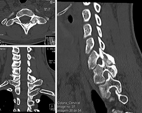 A Rare Case of an Osteoid Osteoma of the Cervical Spine | Case Reports ...