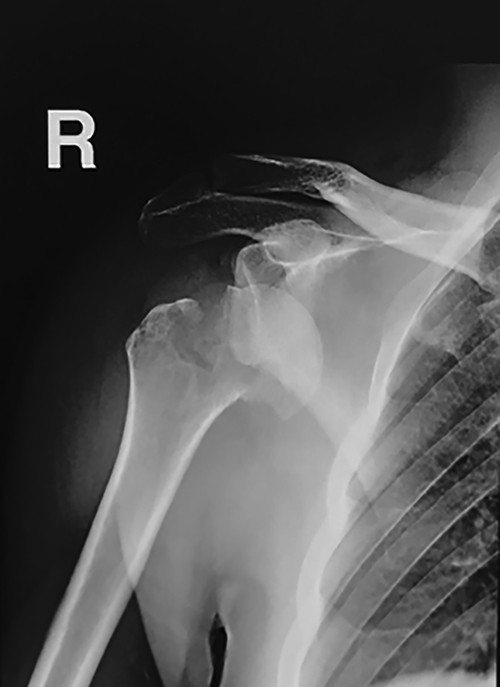 Fracture Dislocation of the Anatomical Neck of the Proximal Humerus ...