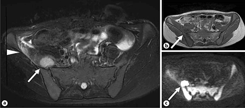 Development of an Iliacus Muscle Abscess after School Exercise in a 17 ...