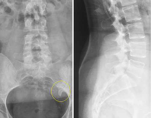 Non-Resolving Sciatica Due to Sacroiliac Joint Osteophyte Compressing ...