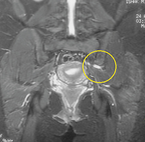Non-Resolving Sciatica Due to Sacroiliac Joint Osteophyte Compressing ...