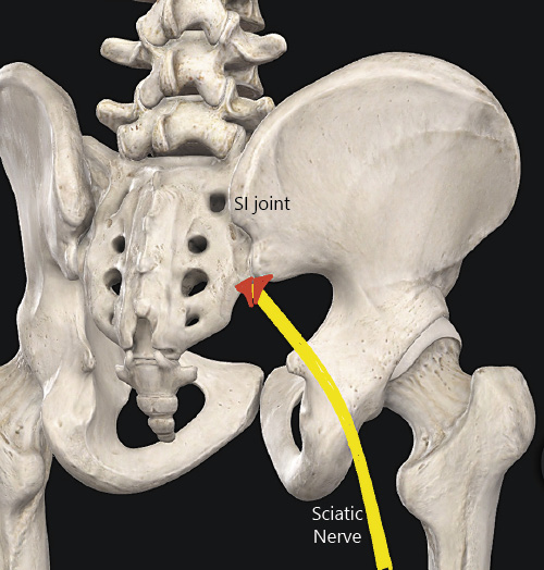 Non-Resolving Sciatica Due to Sacroiliac Joint Osteophyte Compressing ...