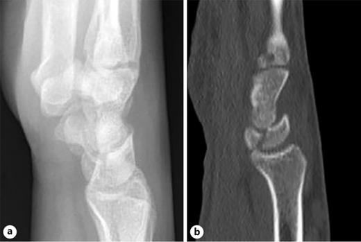 A Very Rare Fracture: Isolated Fresh Lunate Fracture | Case Reports in ...