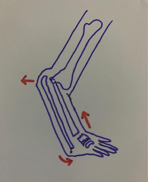 A Rare Combination of Posterior Elbow Dislocation with Ipsilateral ...