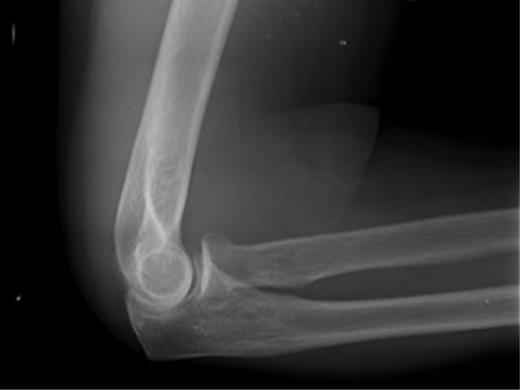 A Rare Combination of Posterior Elbow Dislocation with Ipsilateral ...