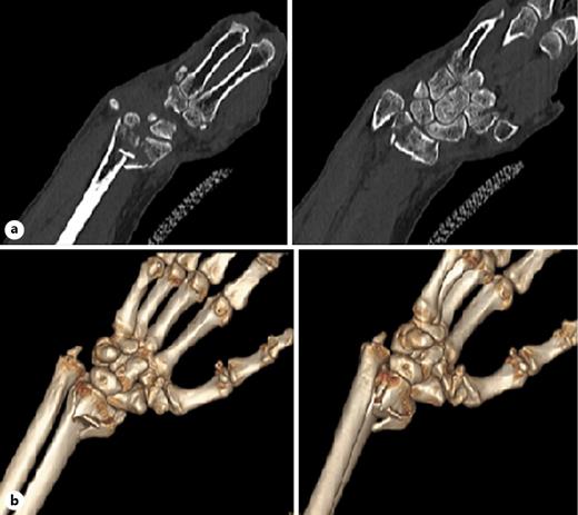 A Rare Combination of Posterior Elbow Dislocation with Ipsilateral ...