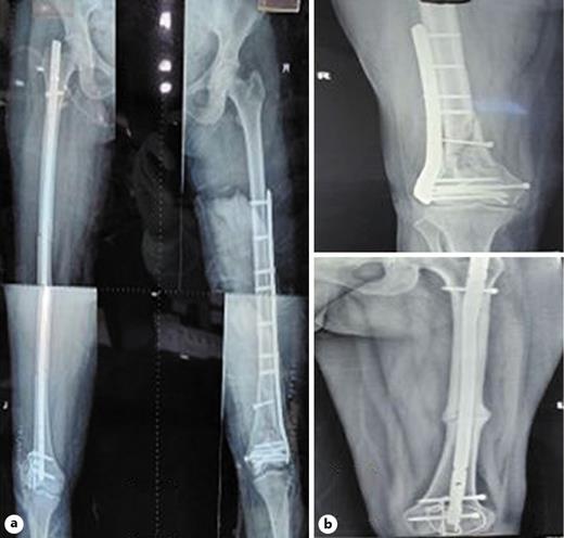 Full Thickness Tear of Quadriceps Tendon Associated with Closed Intra ...