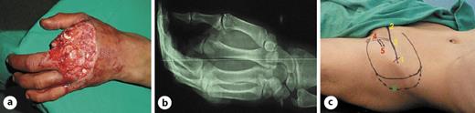 McGregor Pedicled Groin Flap Surgical Technique for Reconstruction of ...