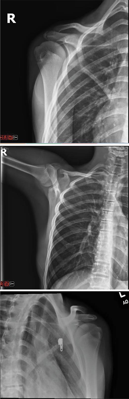 Bilateral Acromioclavicular Joint Subluxation in an Adolescent with ...
